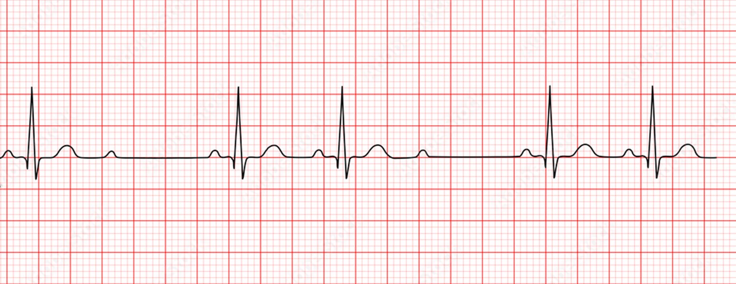 Blocco AV mobitz II - Fisiologia e patologia elettrocardiografica