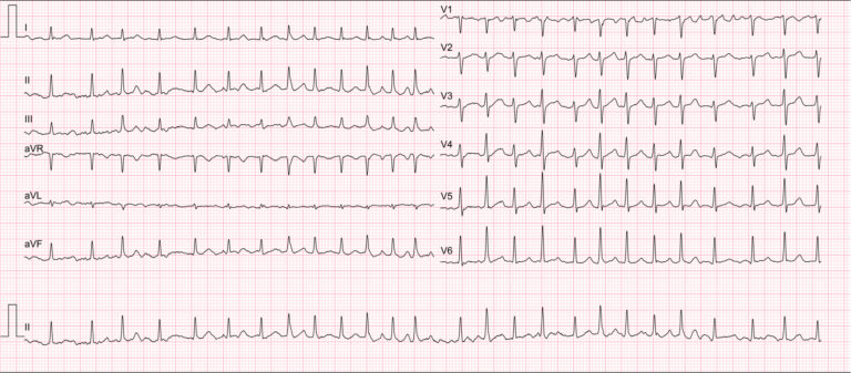 Fibrillazione Atriale - Fisiologia e patologia elettrocardiografica